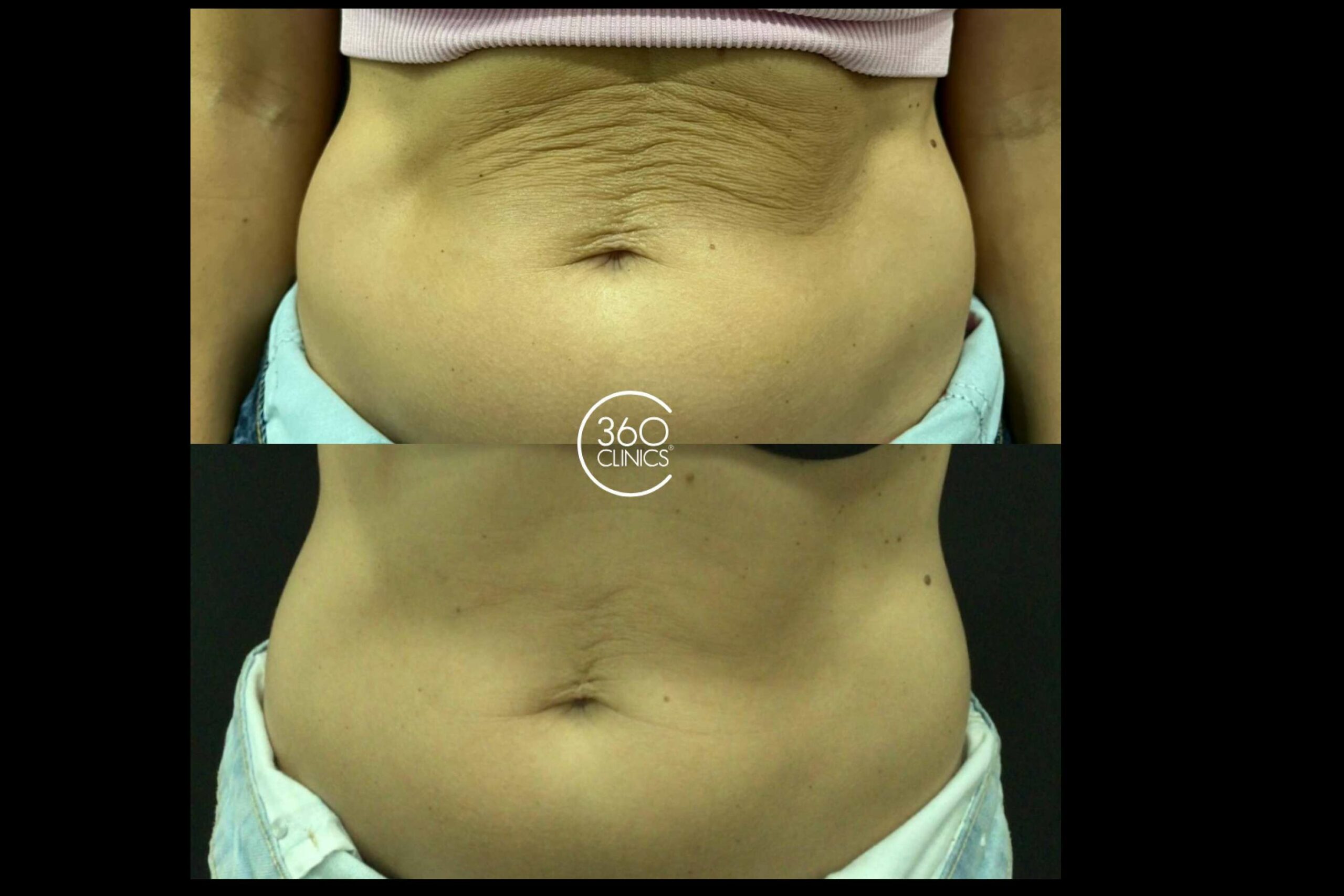 El tratamiento revolucionario para combatir flacidez y celulitis en 360 Clinics - Dicpas